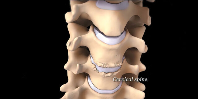 ACDF and ADR - SpineCare Singapore