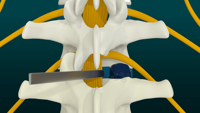 Laminectomy and Discectomy - SpineCare Singapore