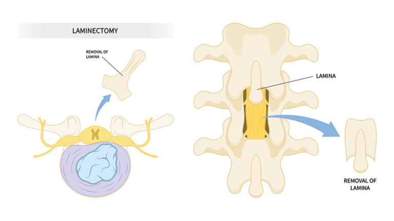 Laminectomy and Discectomy - SpineCare Singapore