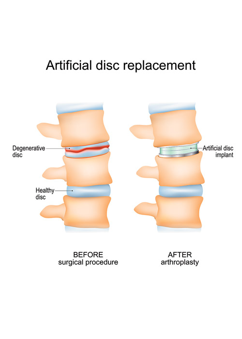 ACDF and ADR - SpineCare Singapore