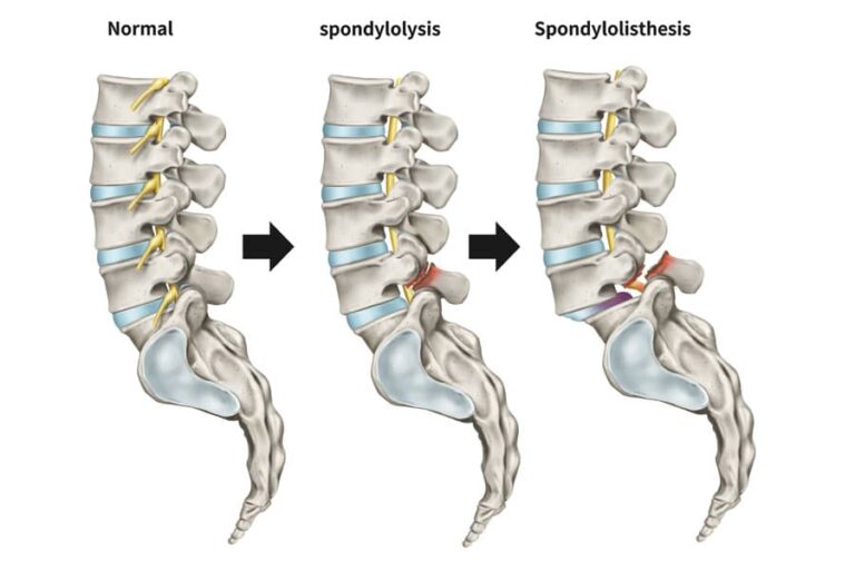 Spondylolisthesis - SpineCare Singapore