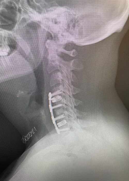 ACDF and ADR - SpineCare Singapore