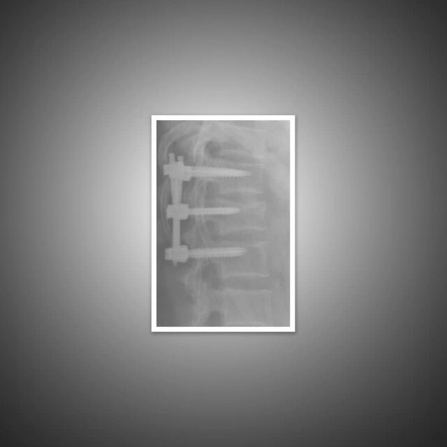 Compression Fractures - SpineCare Singapore