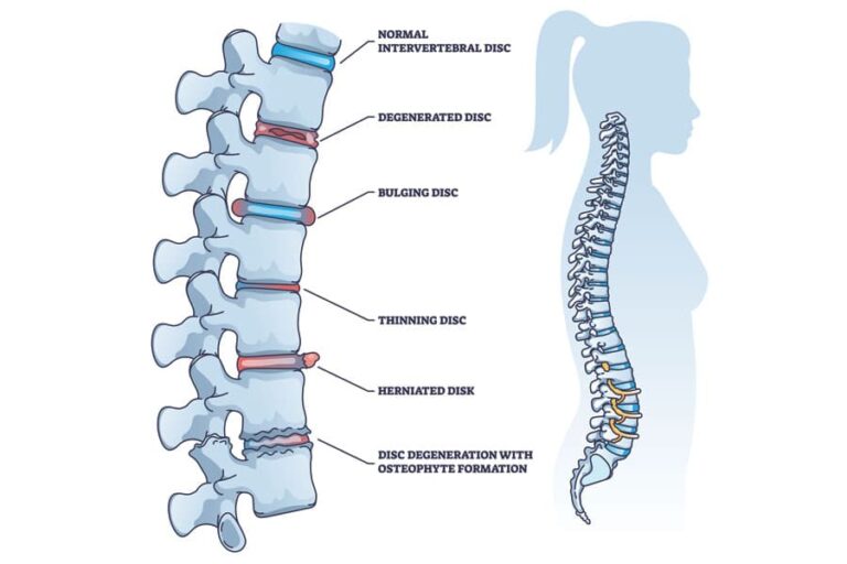 Degenerative Disc Disease - SpineCare Singapore