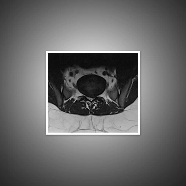 Herniated Disc - SpineCare Singapore