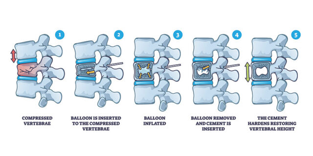 Vertebroplasty and Kyphoplasty - SpineCare Singapore