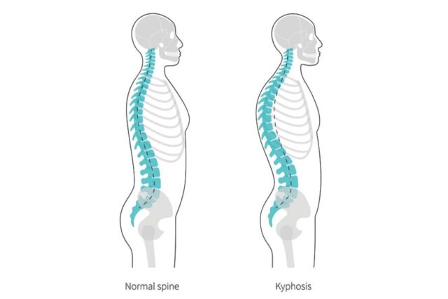 Kyphosis - SpineCare Singapore