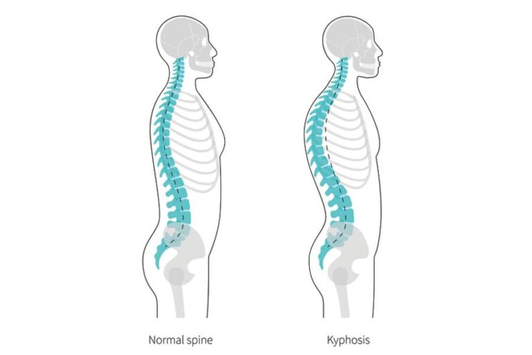 Kyphosis - SpineCare Singapore