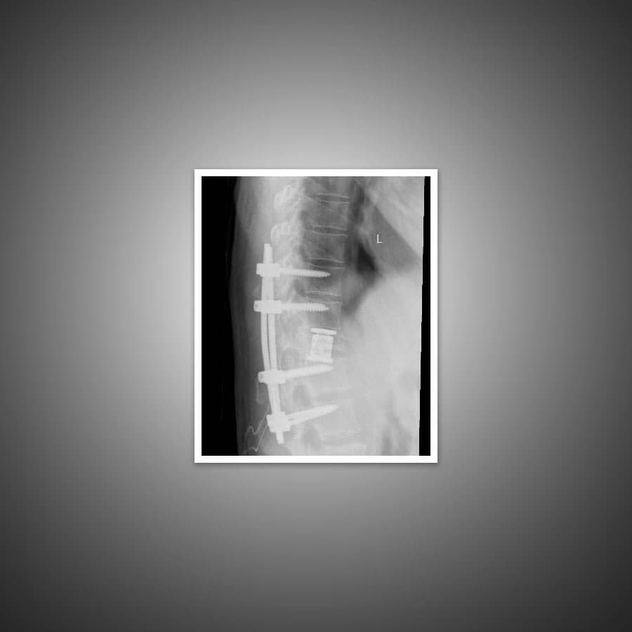Kyphosis - SpineCare Singapore