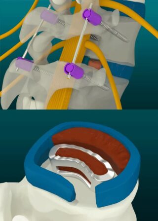 MIS TLIF - SpineCare Singapore