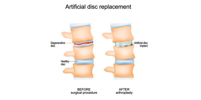 ACDF and ADR - SpineCare Singapore