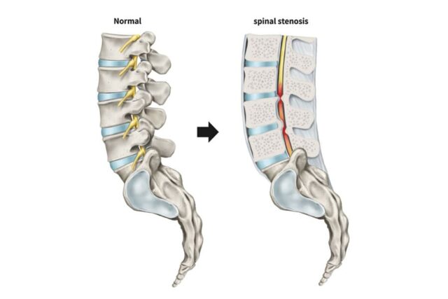 Spinal Stenosis - SpineCare Singapore