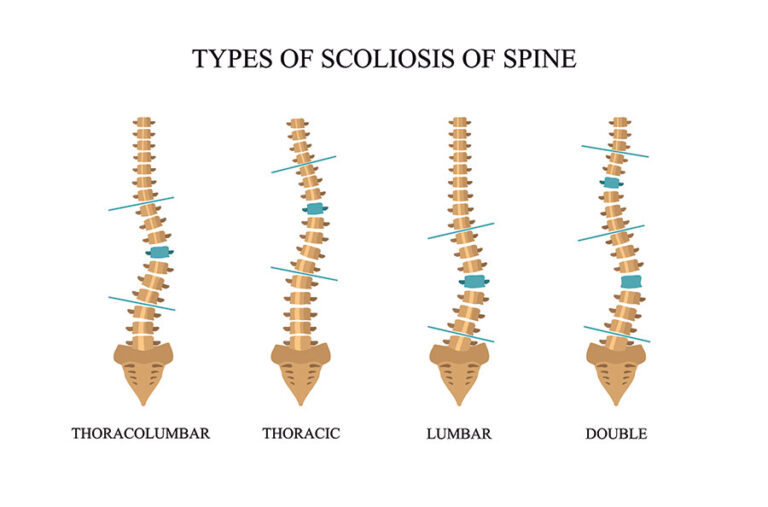 Scoliosis - SpineCare Singapore