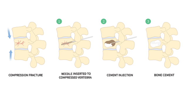 Vertebroplasty and Kyphoplasty - SpineCare Singapore