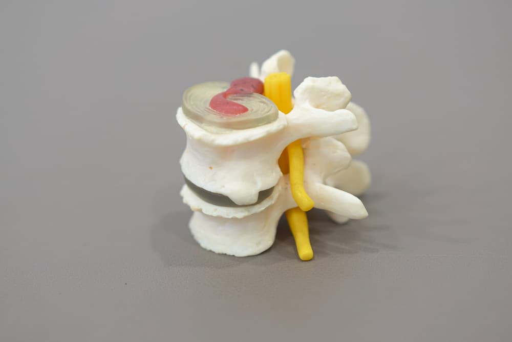 Herniated Disc - SpineCare Singapore