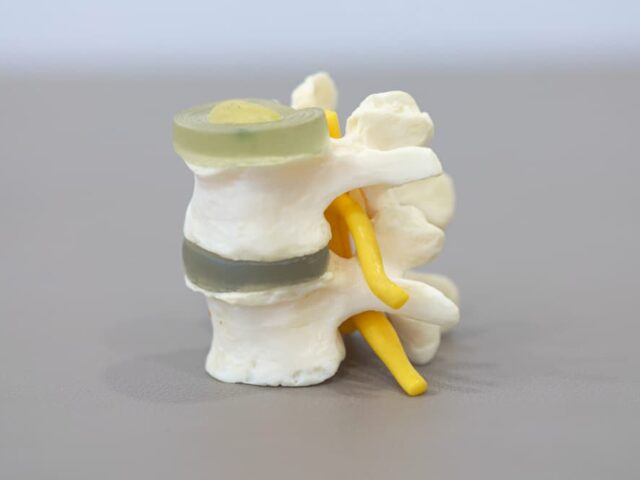 Radiculopathy - SpineCare Singapore