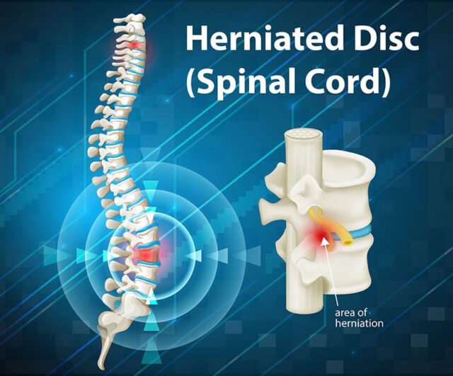 Managing and Treating a Slipped Disc: A Comprehensive Guide - SpineCare ...